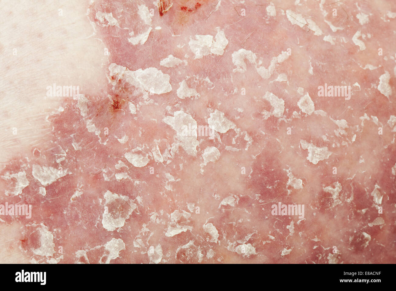 Psoriasis Vulgaris Banque d'image et photos - Alamy