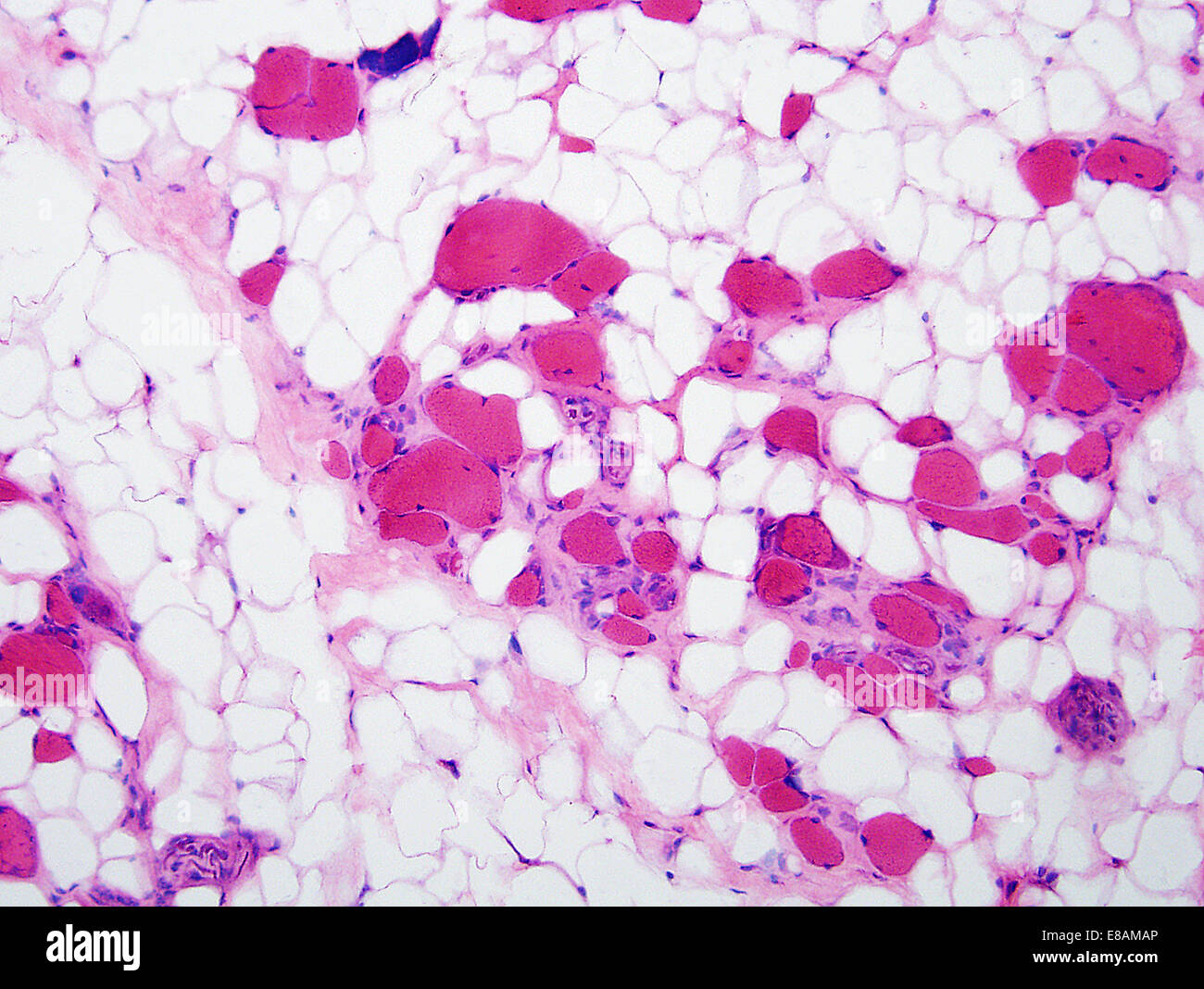La dystrophie musculaire, l'étape de fin Photo Stock - Alamy