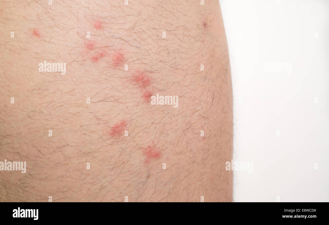 Piqûre de puce Banque de photographies et d’images à haute résolution ...