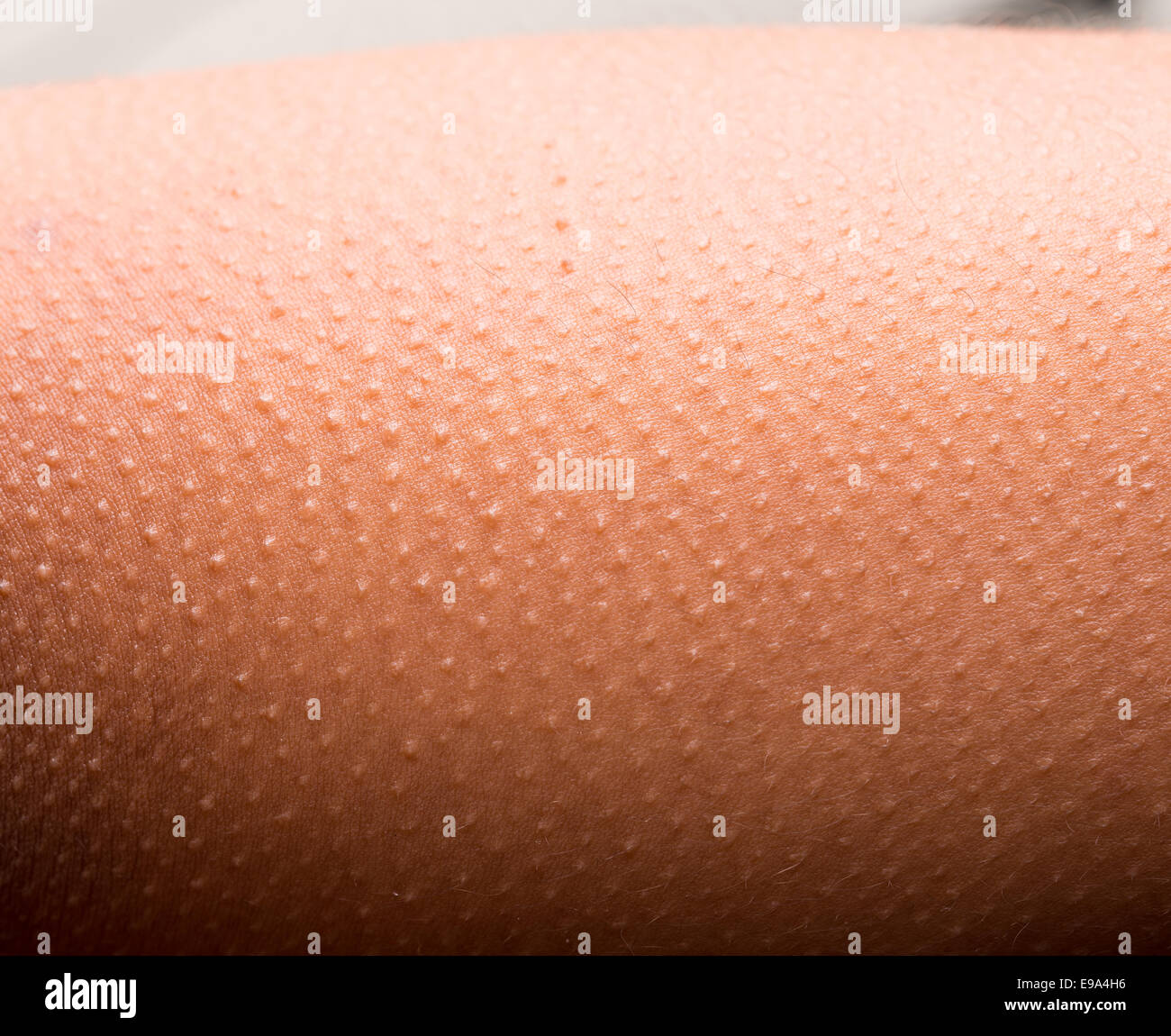 Cutis anserina Banque de photographies et d’images à haute résolution ...