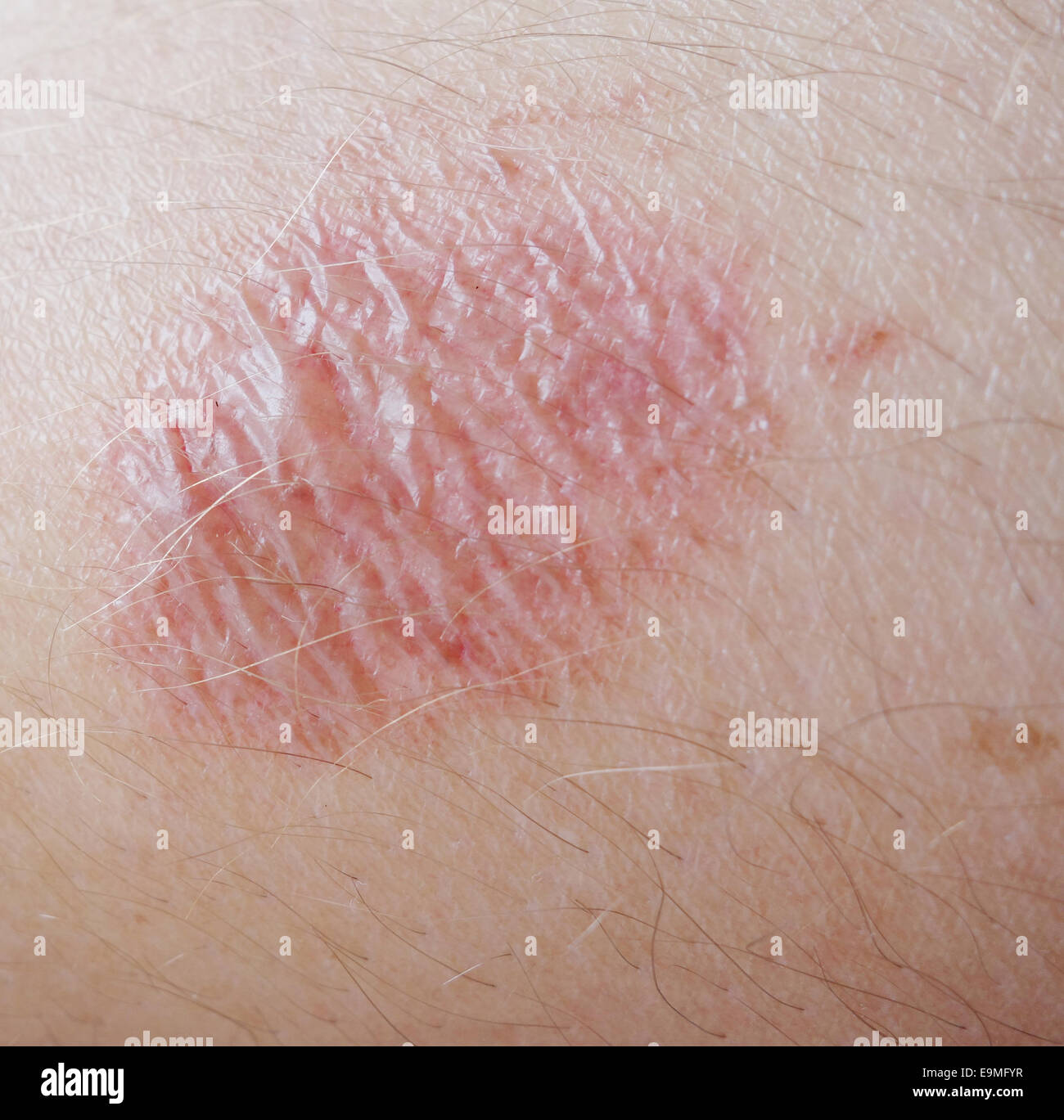 Ulcère de la peau Banque de photographies et d’images à haute ...