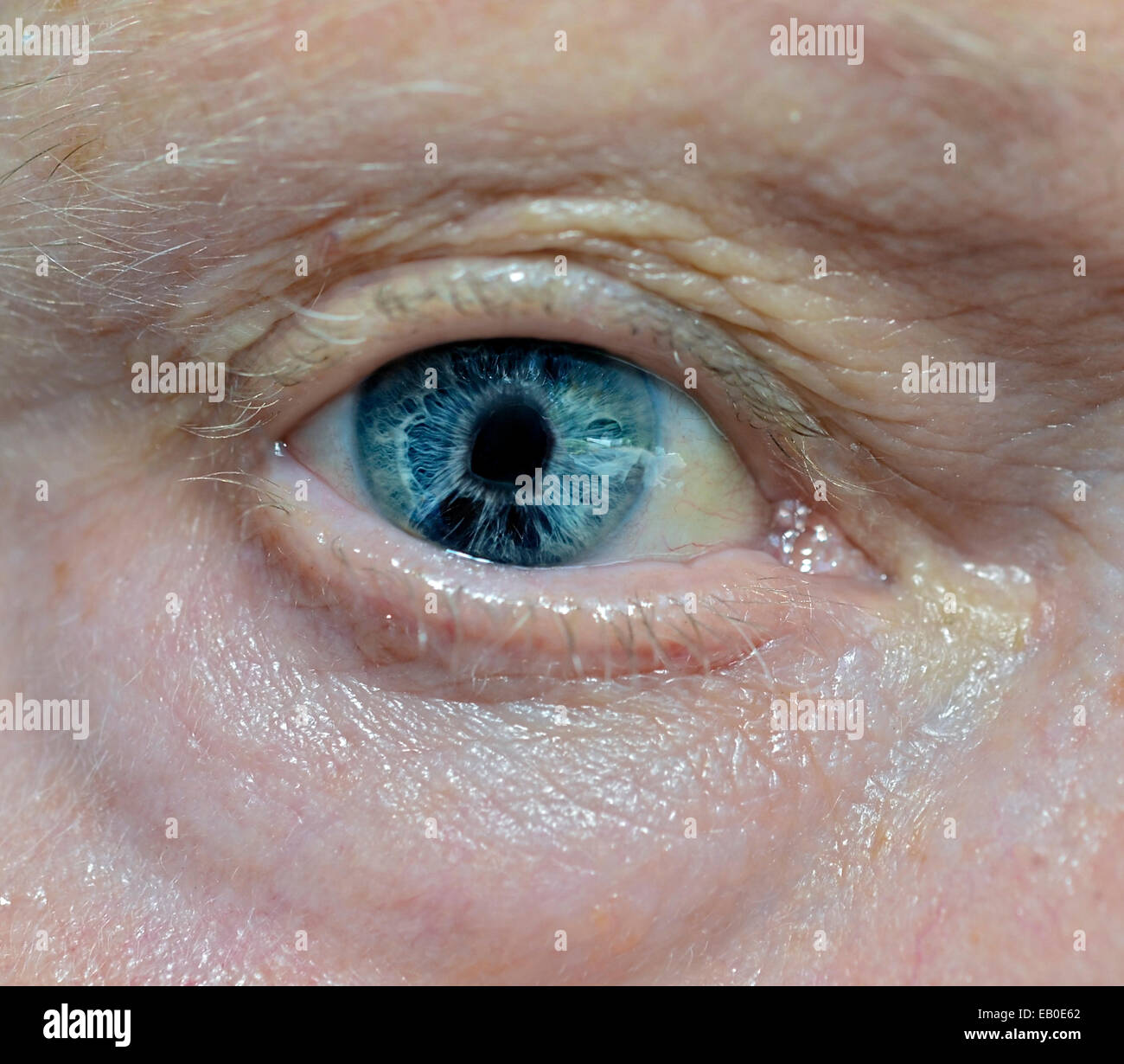 Iridocorneal endothelial syndrome (ICE) est une rare condition oculaire ...