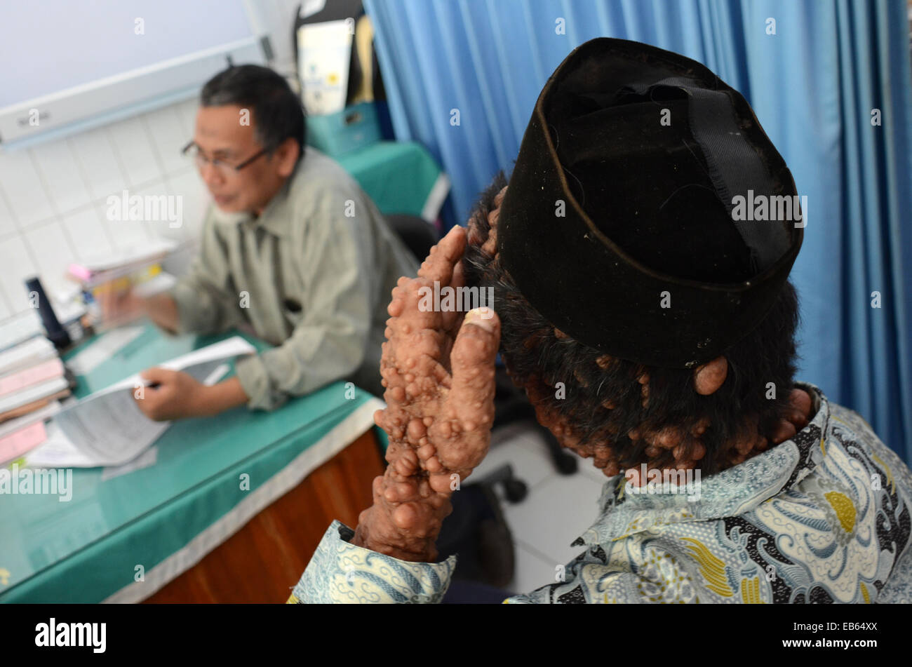 Tumeurs de la peau Banque de photographies et d’images à haute ...