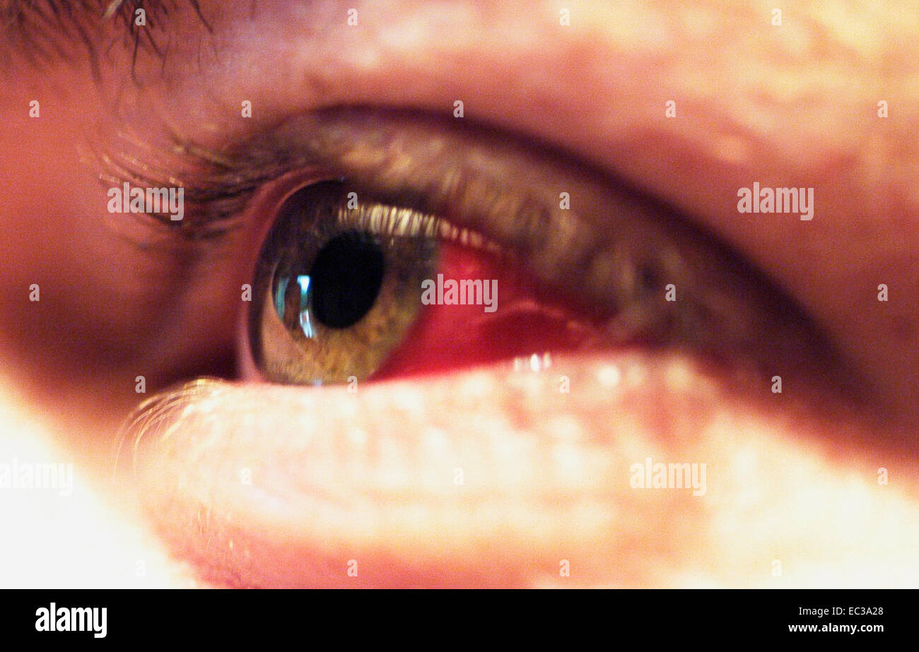 Yeux rouges enflammés Banque de photographies et d’images à haute ...