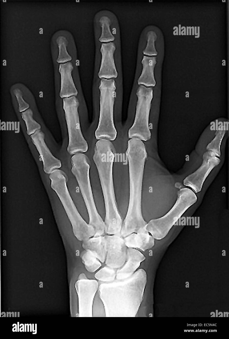 Radiographie de la main Banque d'images noir et blanc - Alamy