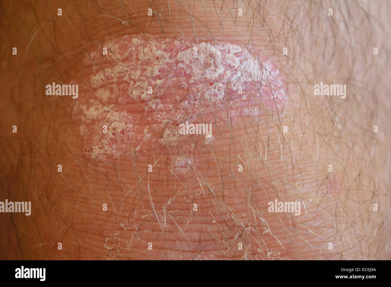 Peau de psoriasis genoux Banque de photographies et d’images à haute ...