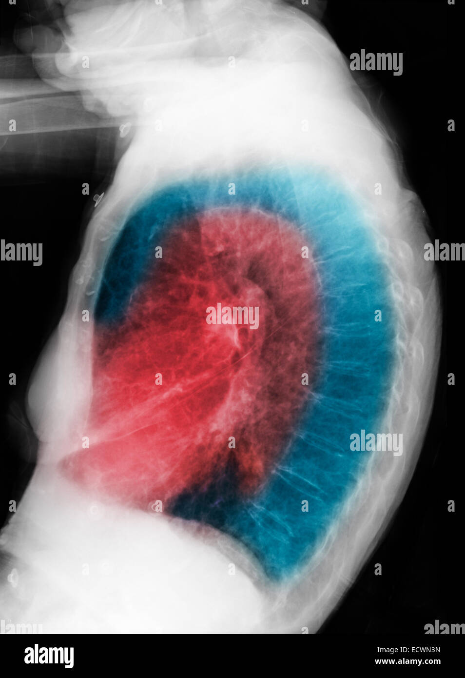 Radiographie montrant une bronchopneumopathie chronique obstructive ...