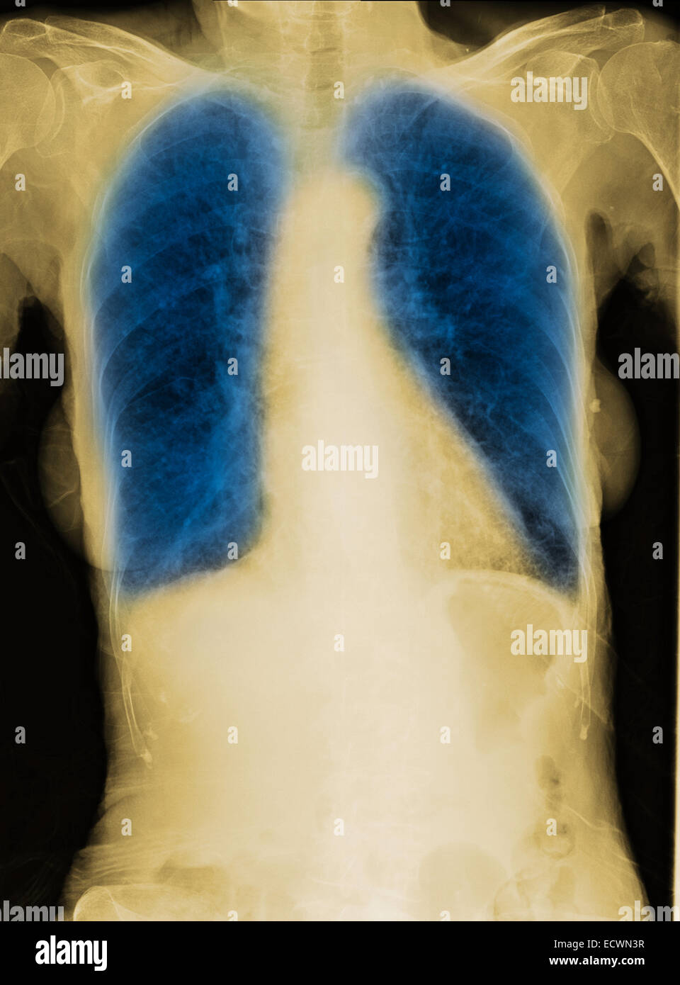 Radiographie montrant une bronchopneumopathie chronique obstructive ...