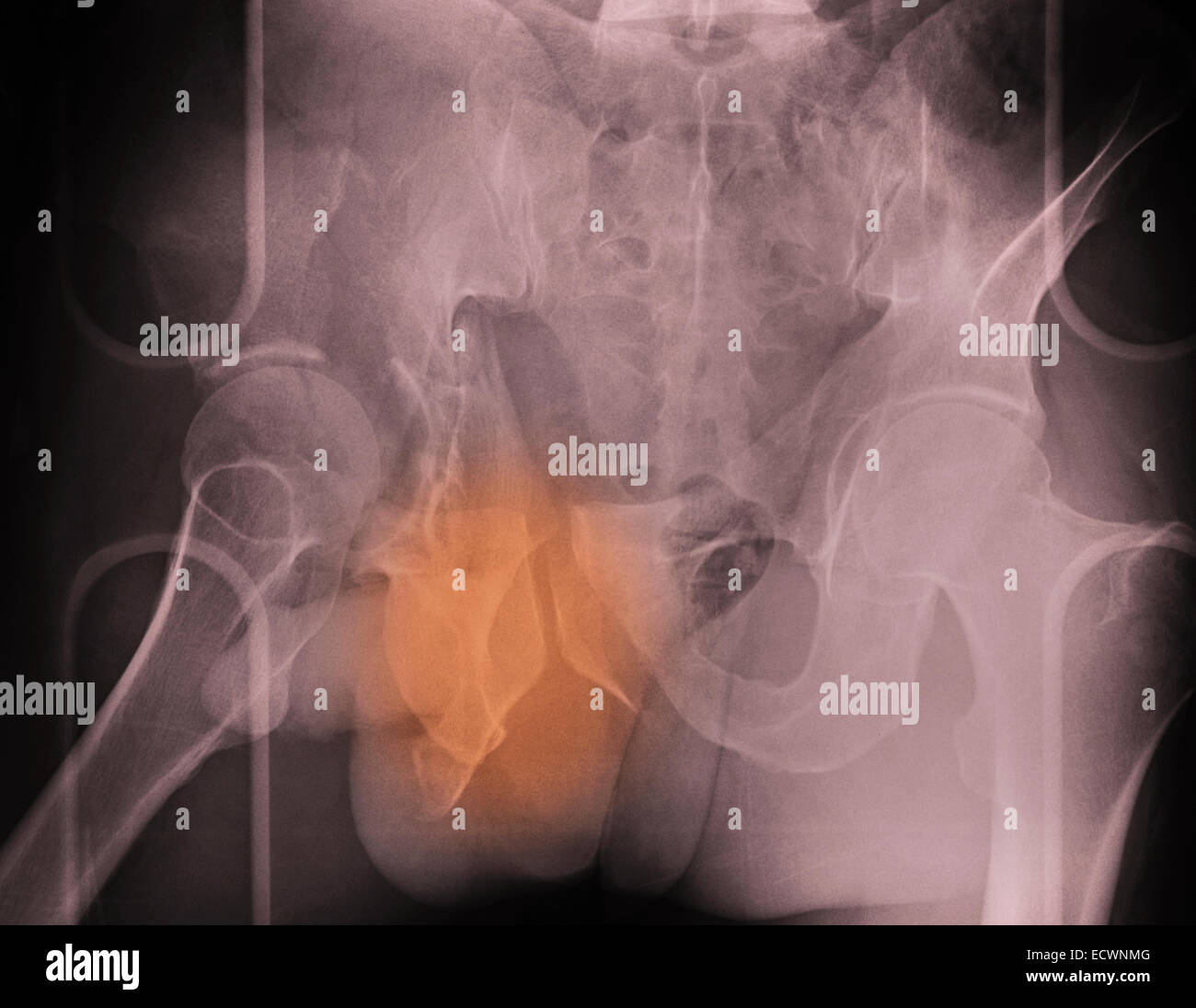 X-ray of a 30 year old man avec une fracture du bassin Photo Stock - Alamy