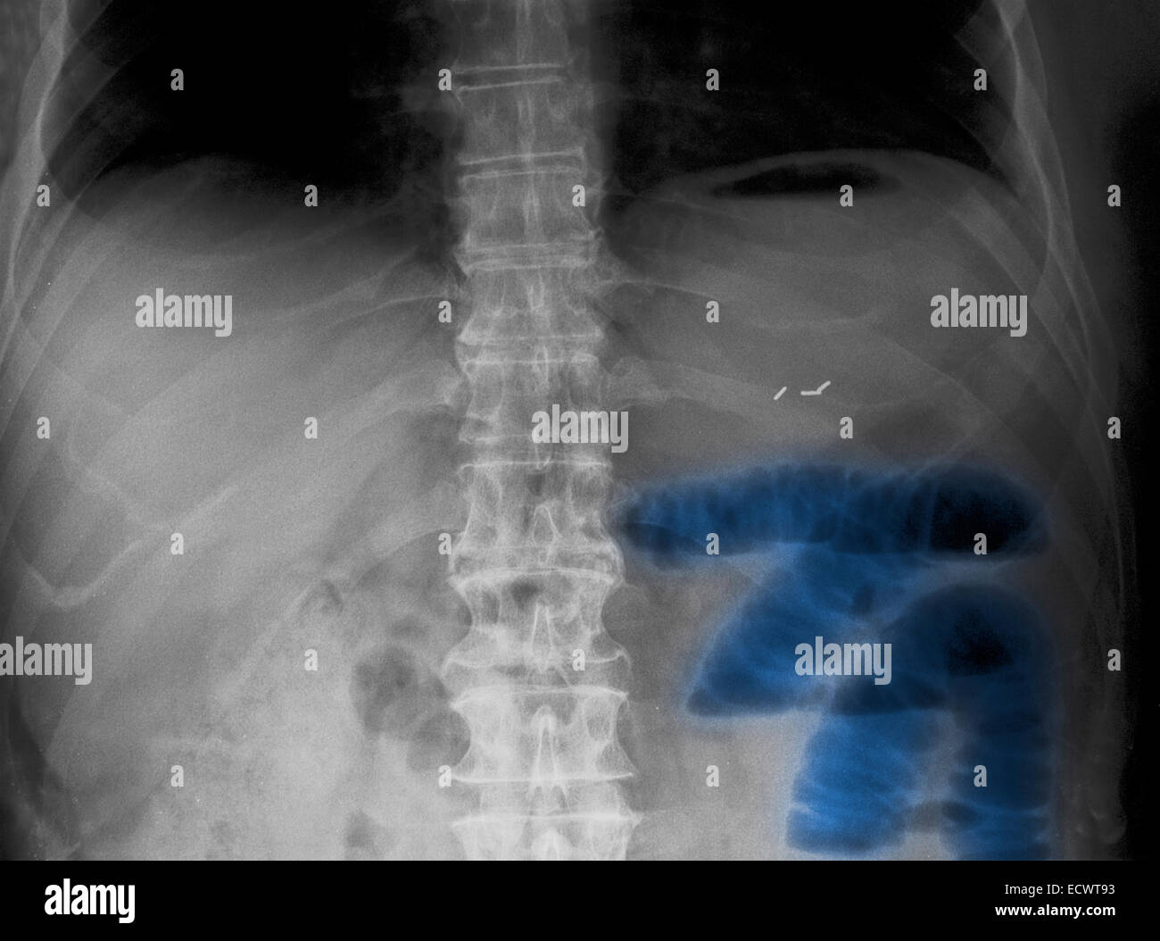 Bowel obstruction Banque de photographies et d’images à haute ...