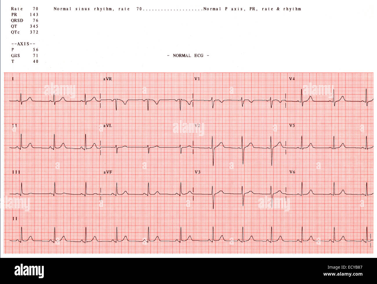 Normal ecg Banque de photographies et d’images à haute résolution - Alamy