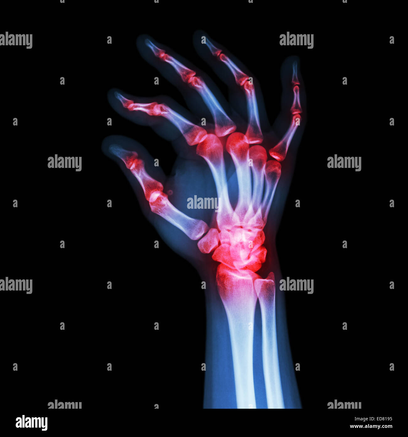 "L'arthrite rhumatoïde, l'arthrite goutteuse" (X-ray mains adultes avec ...