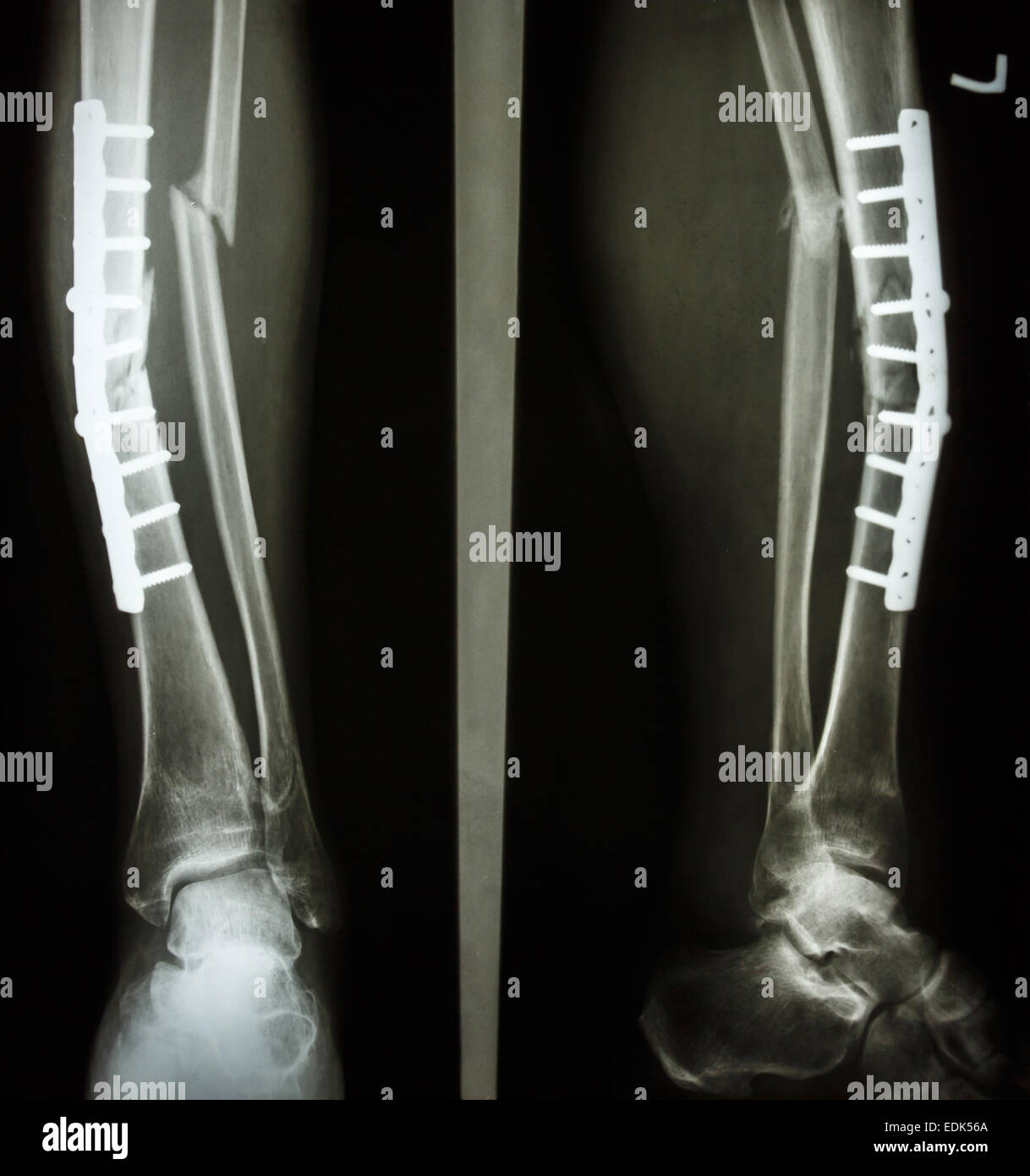 AP/latérale de la jambe du film : montrer l'arbre d'une fracture du ... AP/latérale de la jambe du film : montrer l'arbre d'une fracture du ...