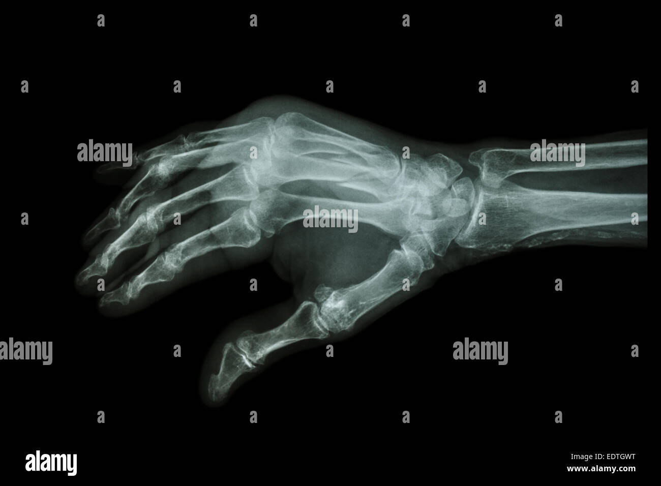 Film X-ray oblique à la main : la rupture à 3e et 4e métacarpe Photo ...