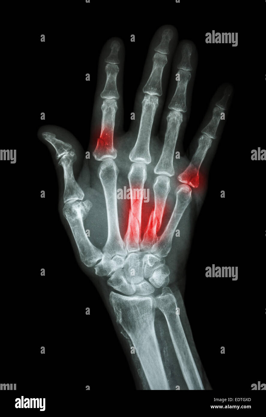 Bone fracture hand Banque de photographies et d’images à haute ...