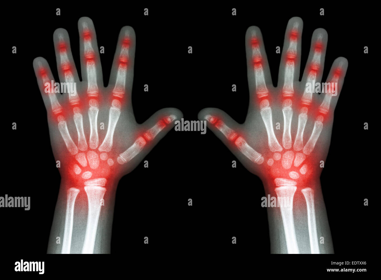 L'arthrite rhumatoïde ( X-ray mains et multiples de l'enfant arthrite ...