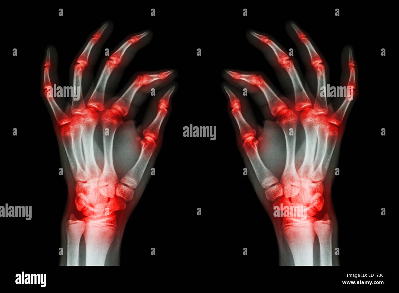 Rayons x de la main Banque de photographies et d’images à haute ...