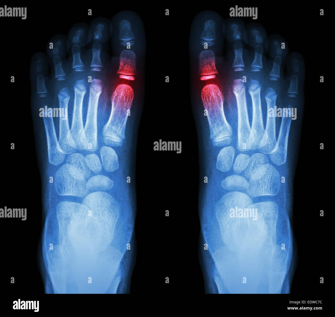 "L'arthrite rhumatoïde, l'arthrite goutteuse' X-ray l'enfant qui paie ...