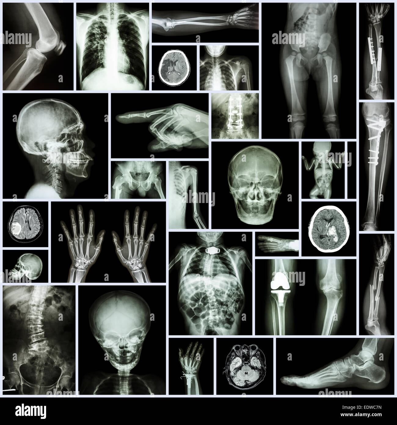 Collection X-ray partie des droits de l,opération orthopédique des ...