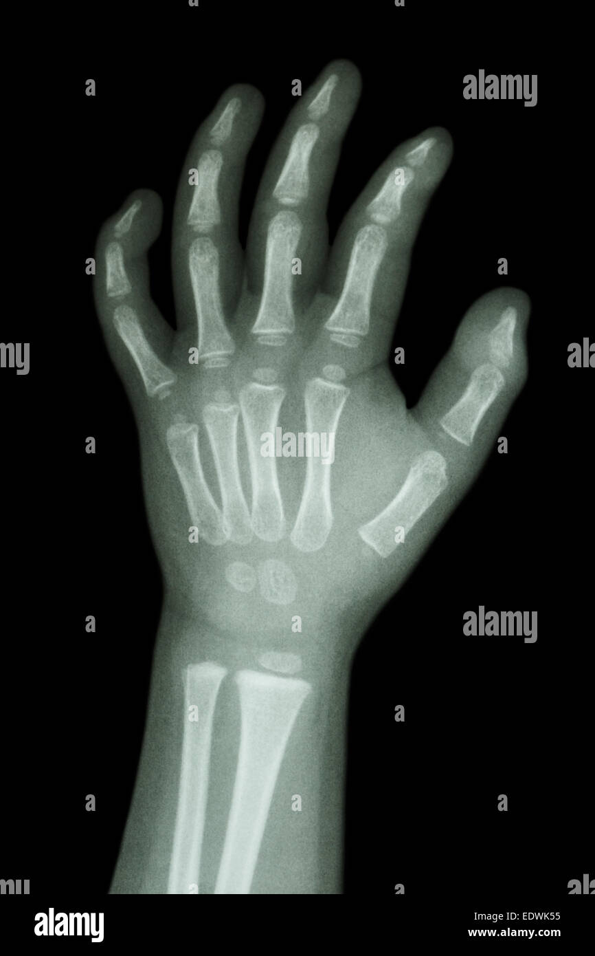 Child Hand X Ray Banque d'image et photos - Alamy