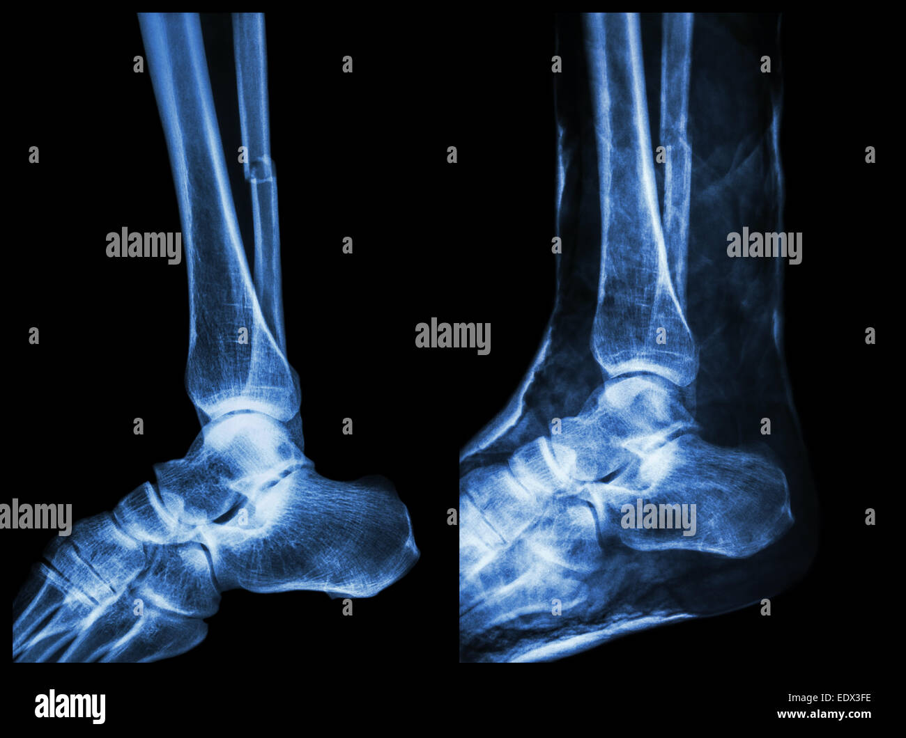 Image de gauche : l'arbre d'une fracture du péroné (os de veau) , image ...