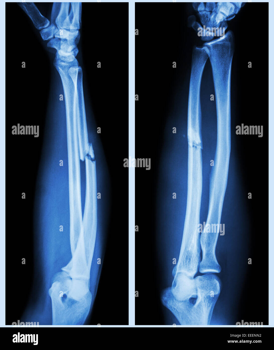 X-ray , avant l'avant-bras ( ) : l'arbre de fracture comminutive os ...