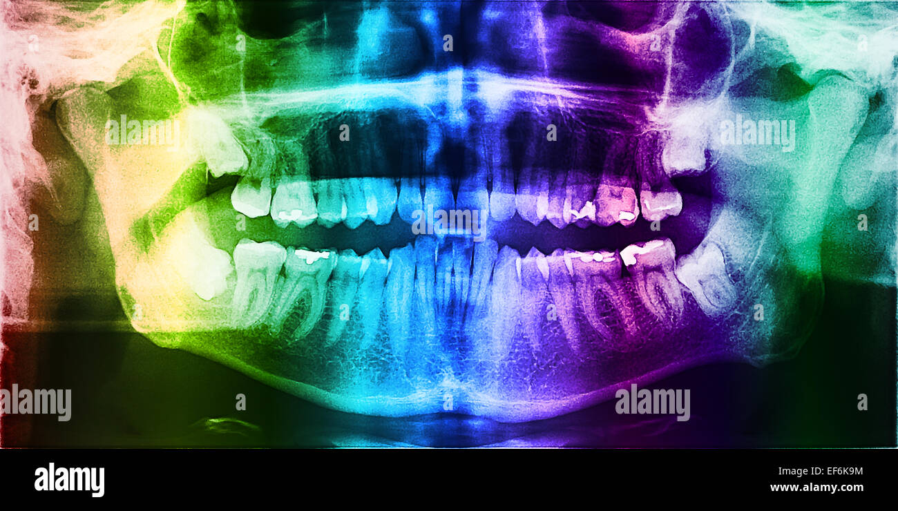 Examen dental de rayos x Banque de photographies et d’images à haute ...
