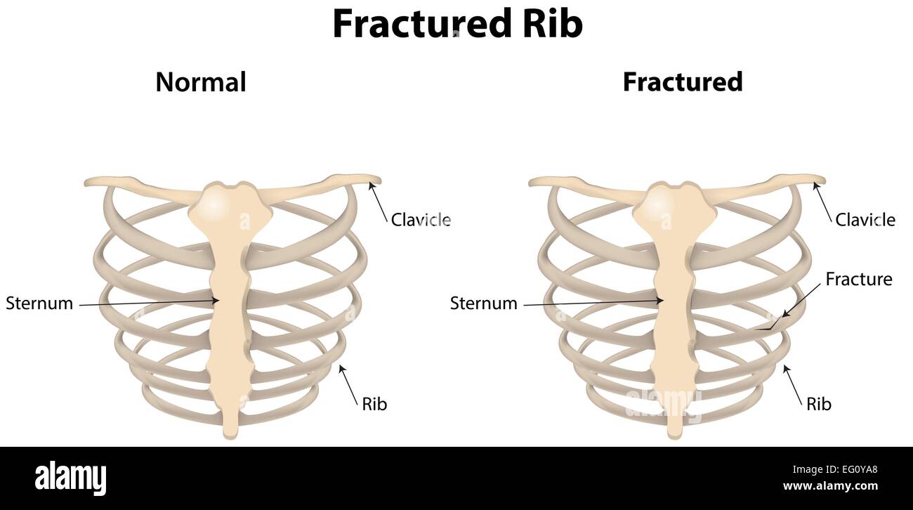 Rib fracture Banque d'images vectorielles - Alamy
