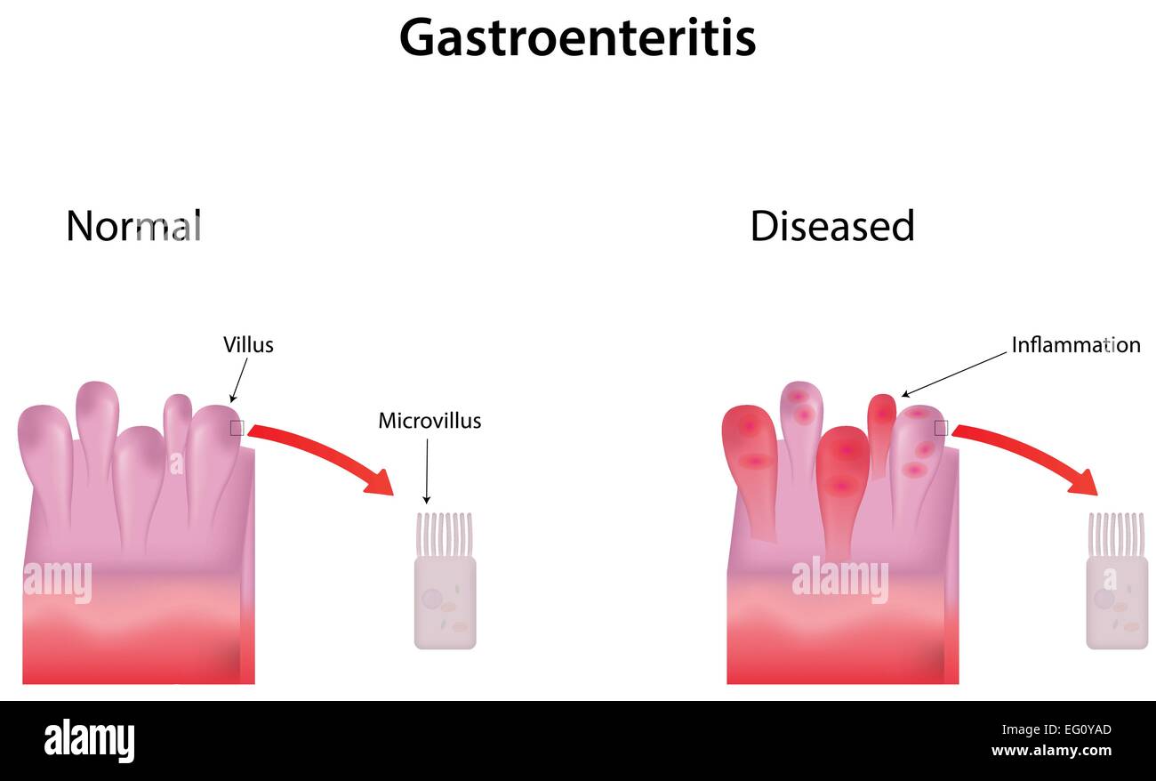 Gastro entérite Banque de photographies et d’images à haute résolution ...
