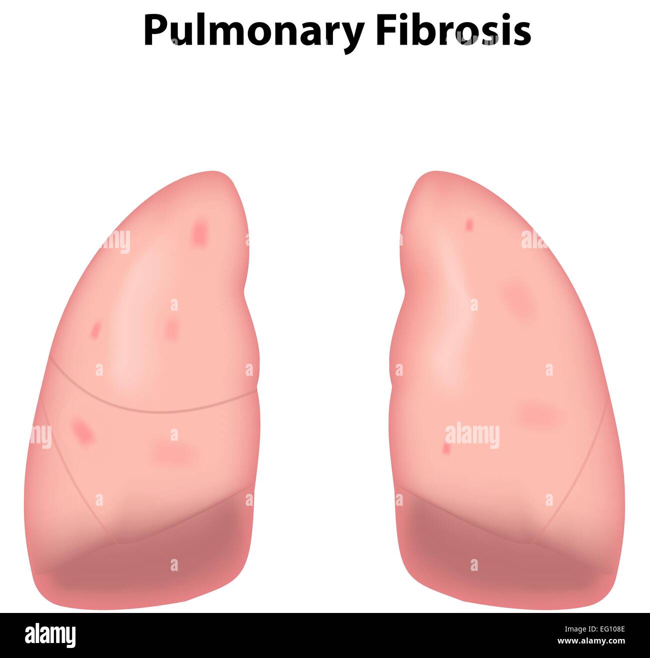Fibrose pulmonaire Banque de photographies et d’images à haute ...