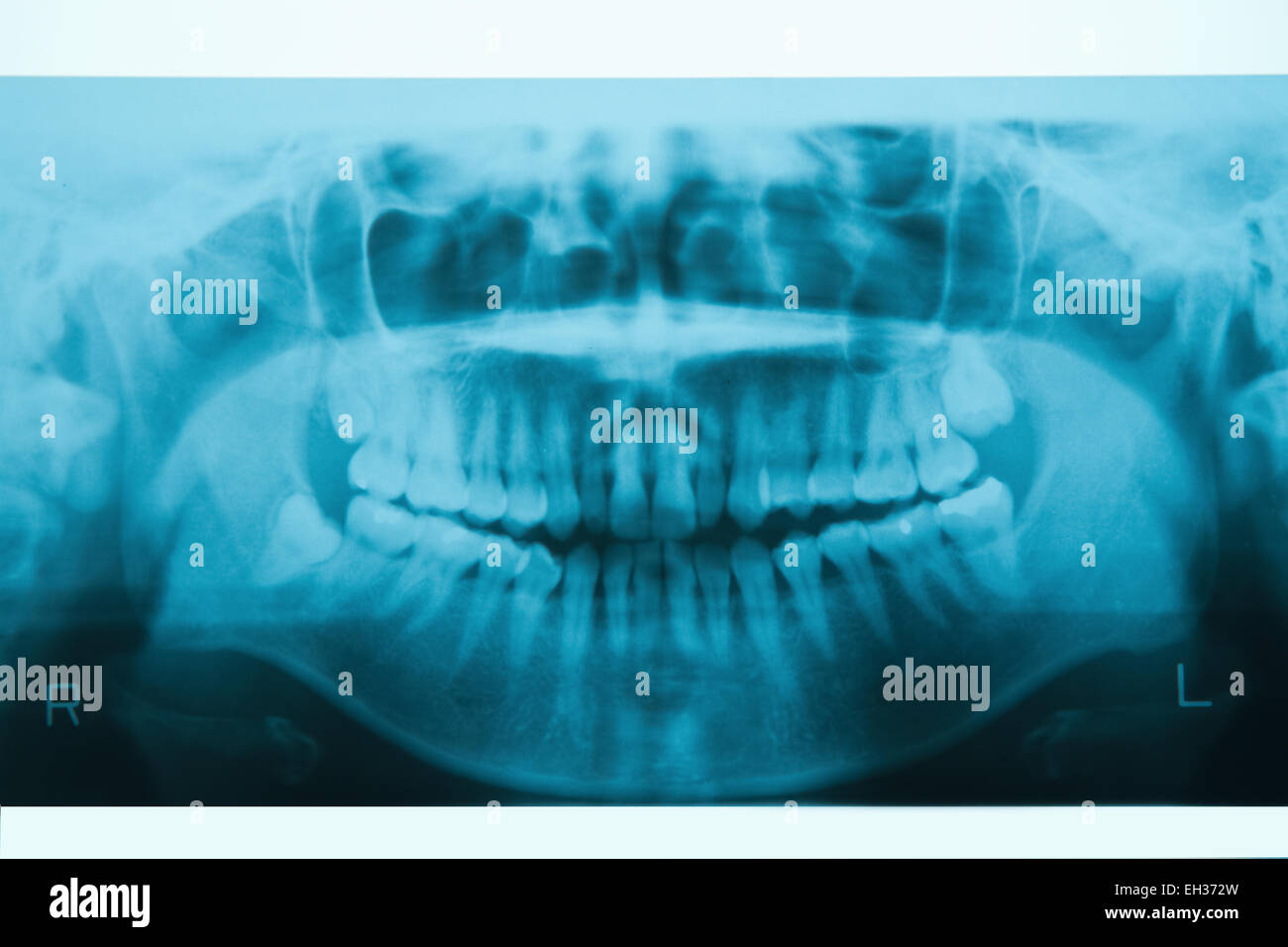 Radiographie dentaire Banque de photographies et d’images à haute ...