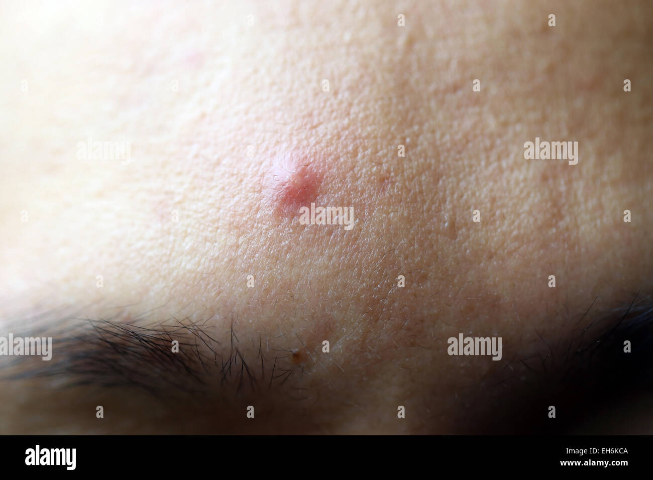 Acne woman Banque de photographies et d’images à haute résolution - Alamy