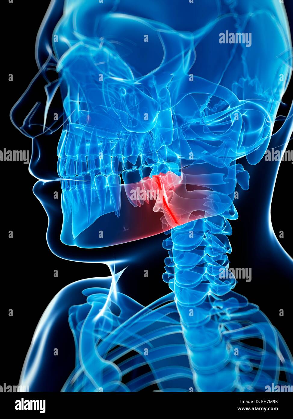 L'os de la mâchoire cassée, illustration Photo Stock - Alamy