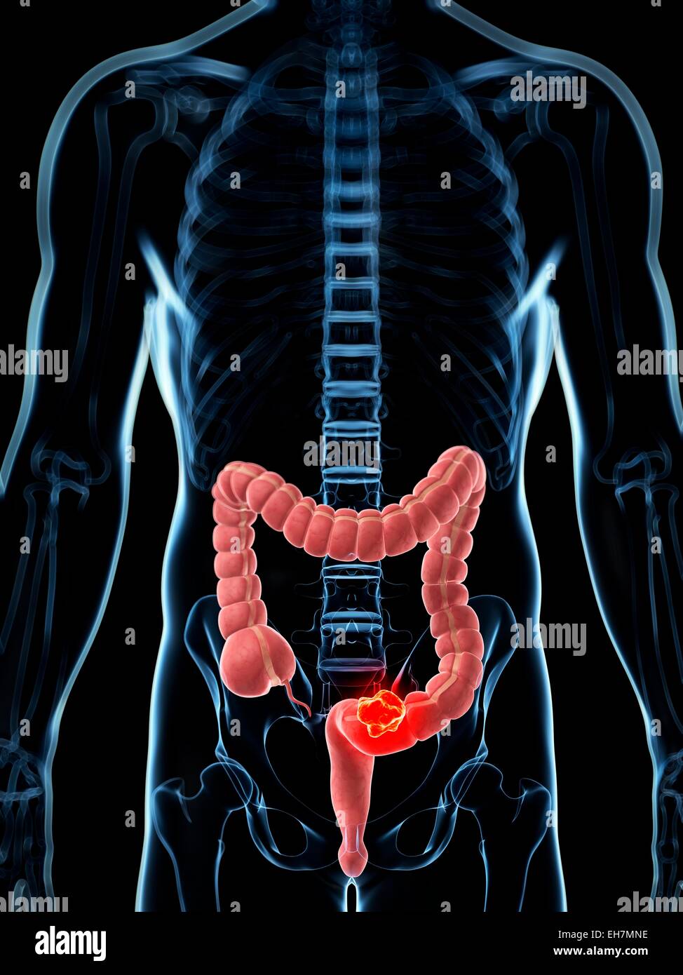 Cancer du colon humain Banque de photographies et d’images à haute ...