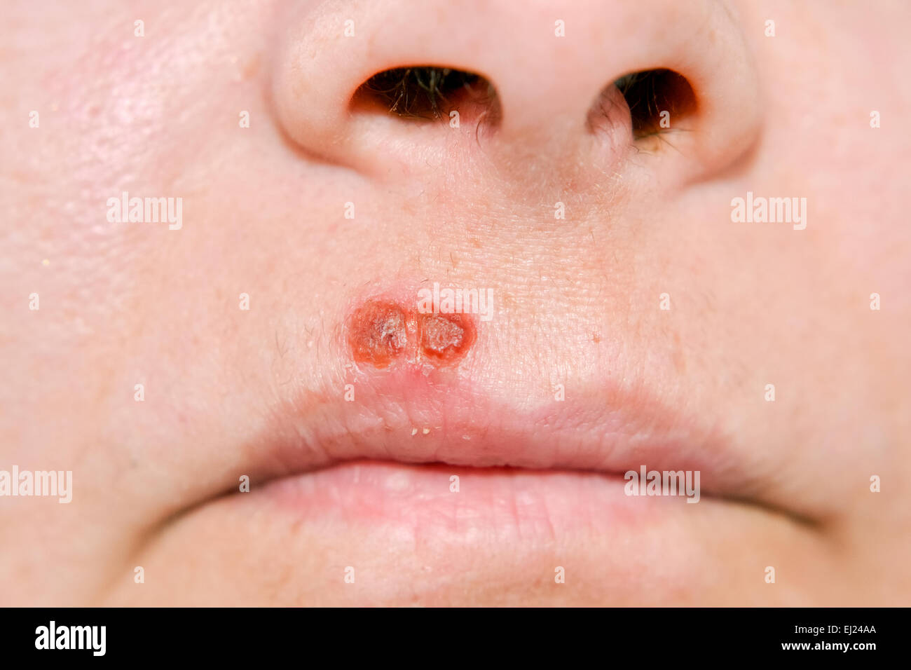 Ulcère de la peau Banque de photographies et d’images à haute ...