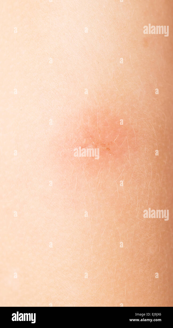 Tache rouge peau Banque de photographies et d’images à haute résolution ...