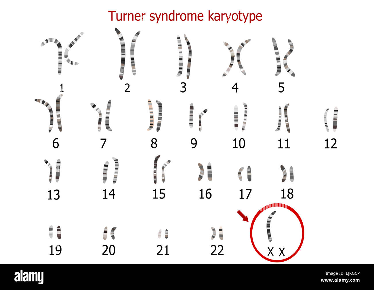 Syndrome De Turner Caryotype Banque De Photographies Et Dimages à