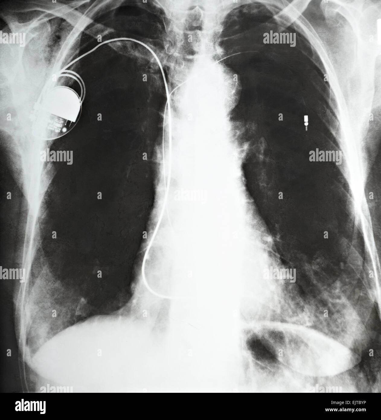 Radiographie du stimulateur cardiaque Banque de photographies et d ...