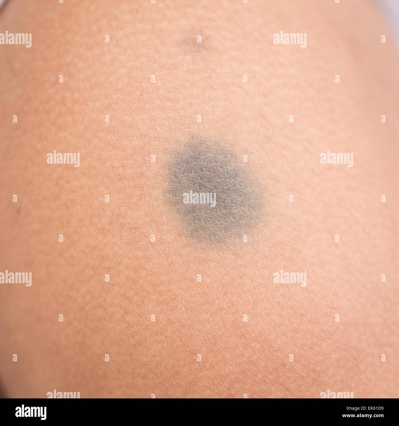 Naevus épidermique Banque de photographies et d’images à haute ...