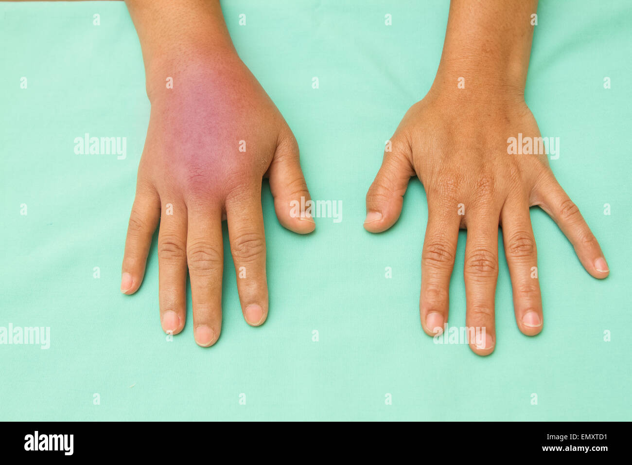 Main enflée Banque de photographies et d’images à haute résolution - Alamy