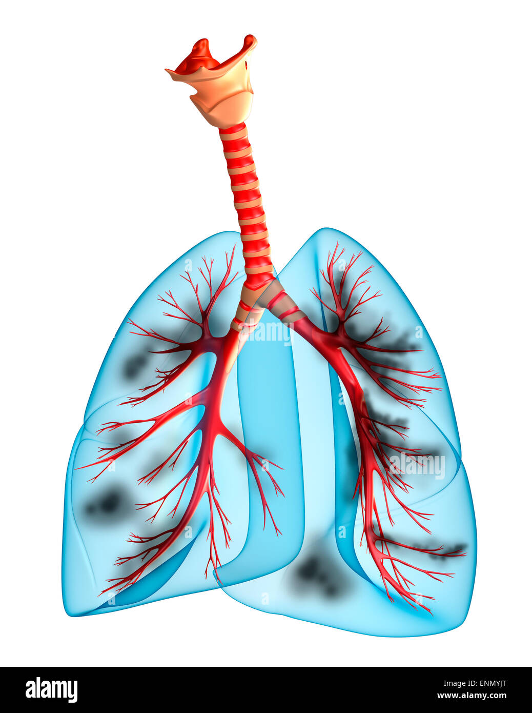 Poumons malades Banque de photographies et d’images à haute résolution ...