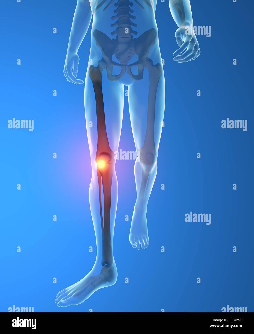 Le squelette d'hommes, de race de la douleur de l'inflammation du genou ...