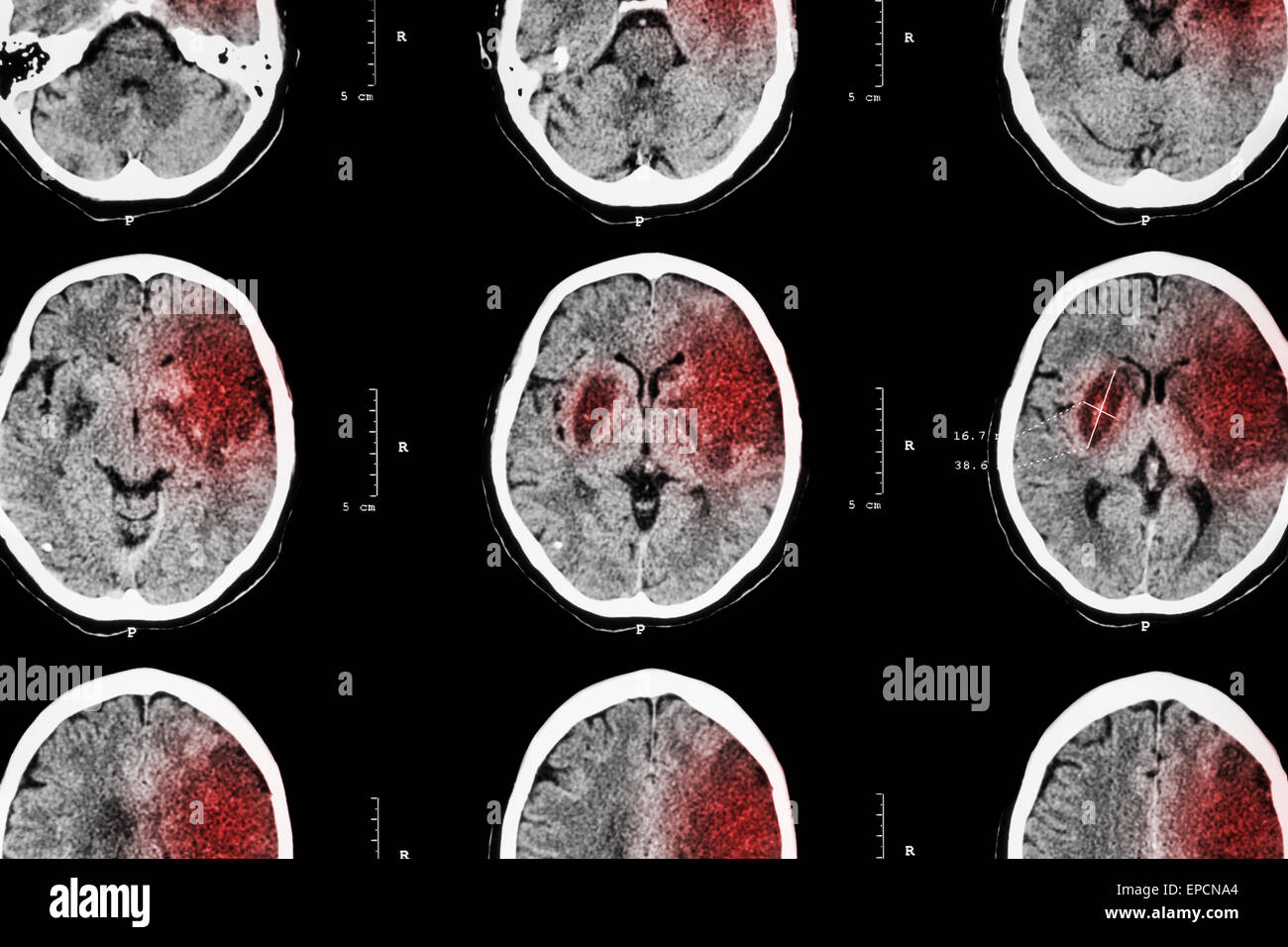 Avc ischémique : ( CT de cerveau indiquent l'infarctus cérébral à ...