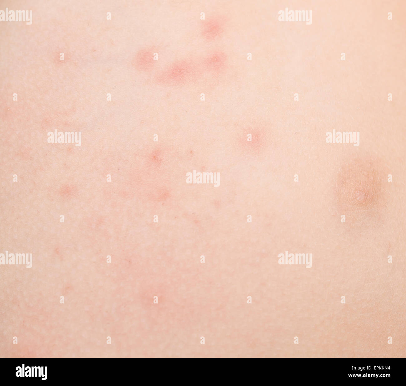 Itchy rash Banque de photographies et d’images à haute résolution ...