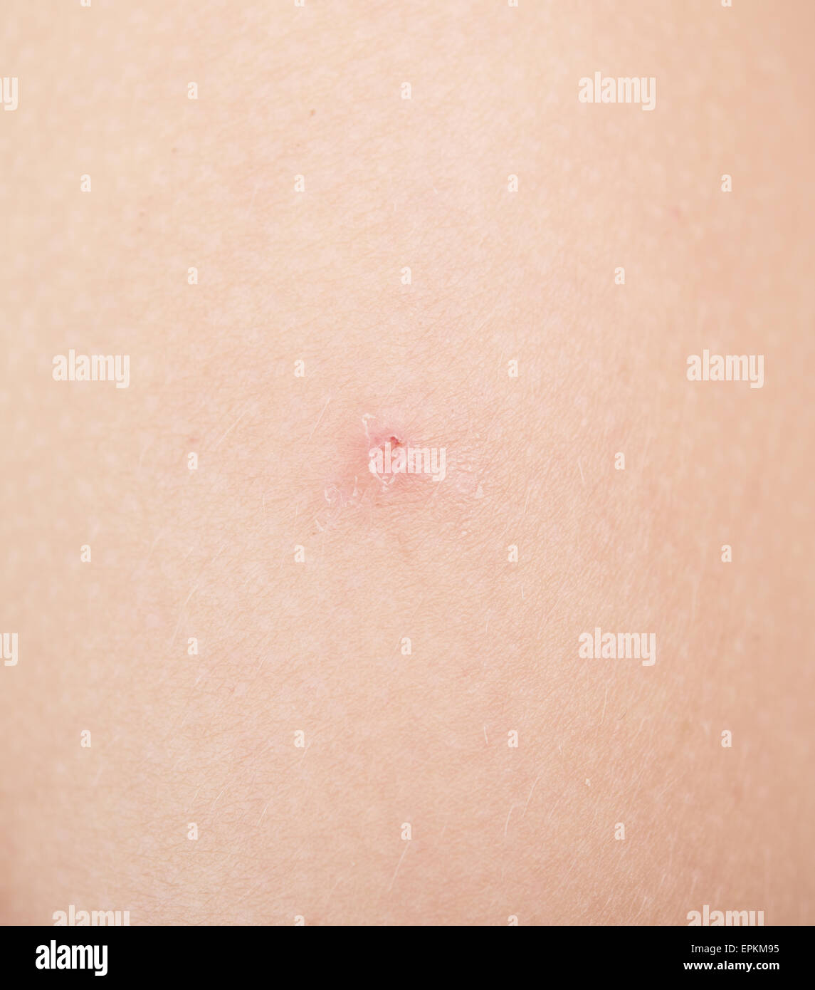 piqûre d’insecte Photo Stock - Alamy