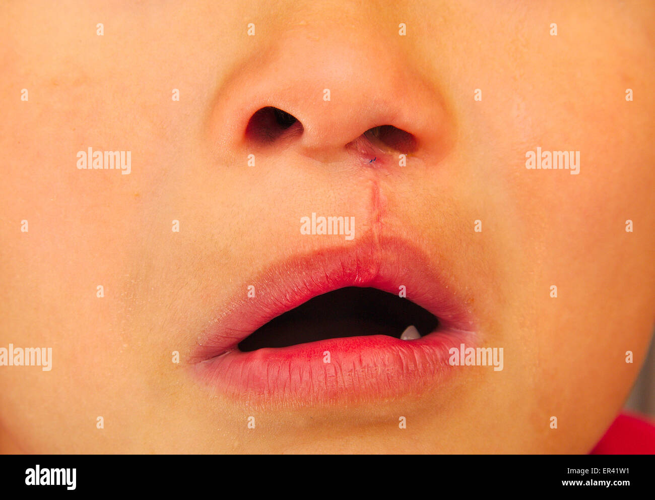 Chirurgie a coeur ouvert garçon Banque de photographies et d’images à ...