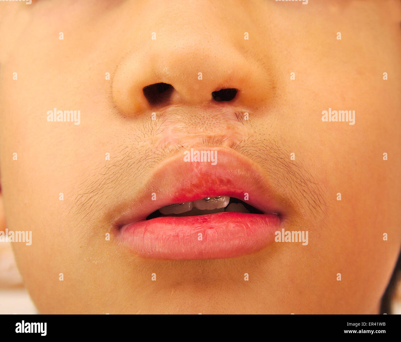 Unilateral cleft lip Banque de photographies et d’images à haute ...