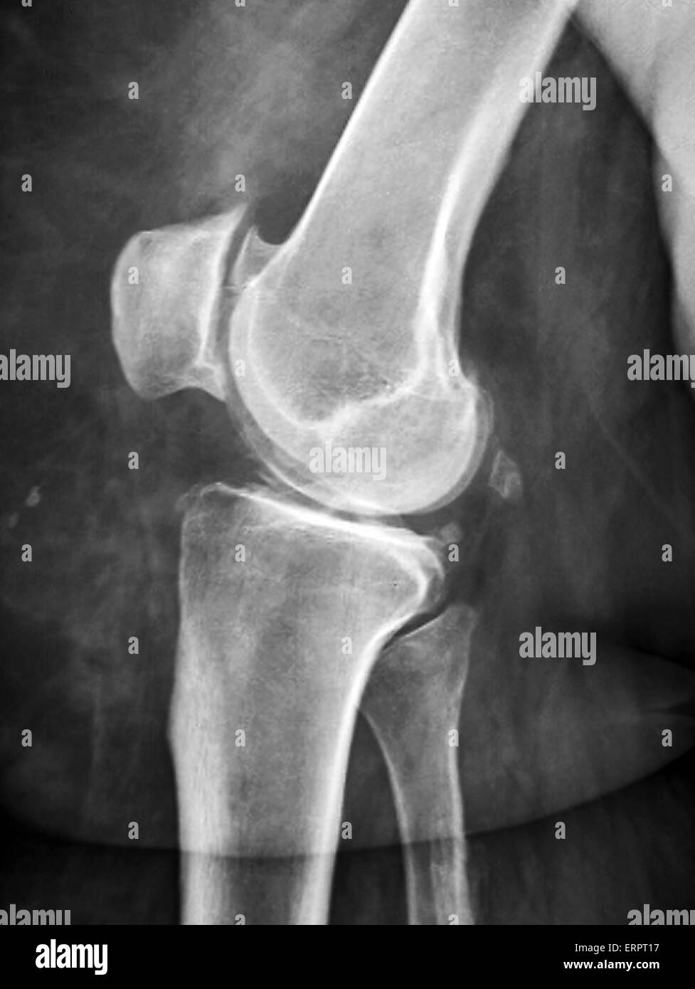 Arthrite du genou radiographie Banque de photographies et d’images à ...