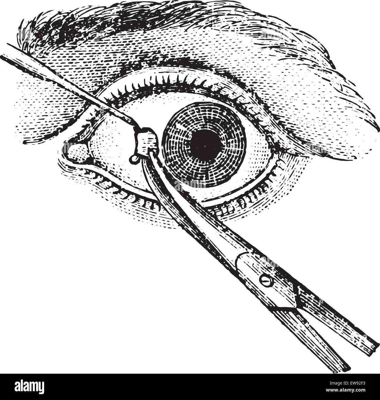 Chirurgie du strabisme Banque de photographies et d’images à haute ...