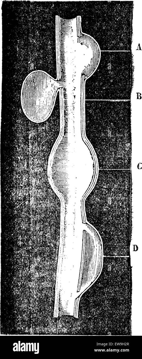 Anévrisme Sacculaire Banque d'image et photos - Alamy